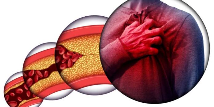 Srčani udar Posljedice i Simptomi - eDoktor