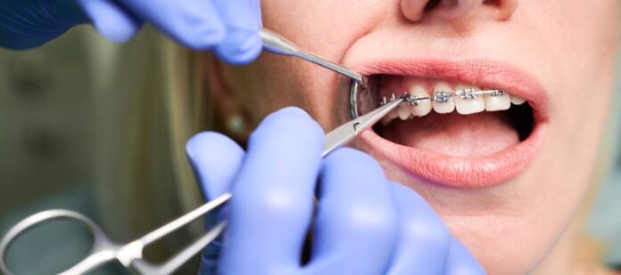 Aparatić za zube - vrste, bolovi i koliko se nosi - eDoktor